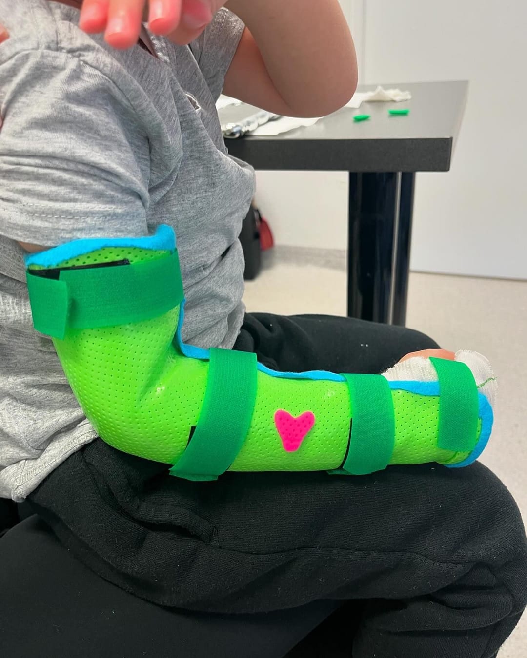 Thermoplastic Solutions for Hand Therapy and Face Protection